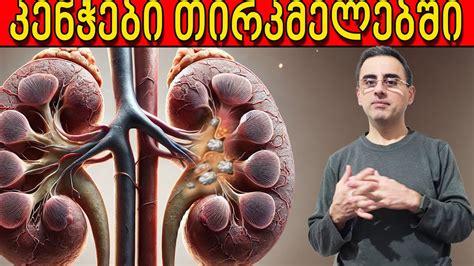 კენჭები თირკმელში ნიშნები სიმპტომები და მკურნალობა Youtube