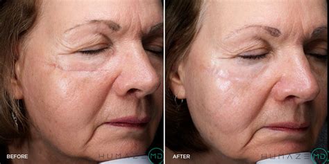 Scars Plymouth Meeting Dermatology