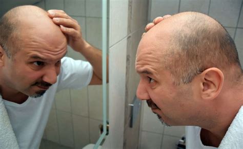 4 Early Signs Of Hair Loss You Shouldnt Ignore Suntrics