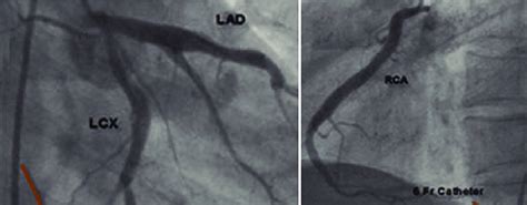A Coronary Angiogram In Right Anterior Oblique View Shows Left Download Scientific Diagram