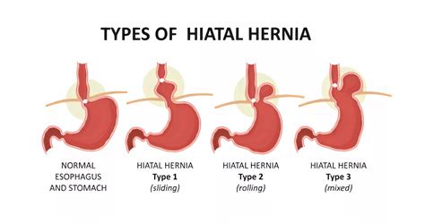 Hiatal Hernia What It Is And How To Manage It