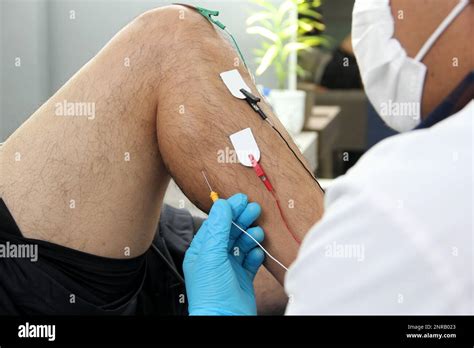 Electromyography Emg And Somatosensory Evoked Potential Pev Of Lower