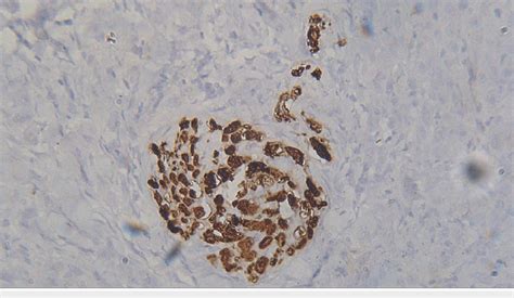 Photomicrograph Showing Expression Of Cd57 In Pdscc Ihc Staining 400x