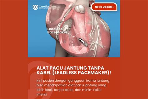 Leadless Pacemaker Inovasi Baru Dalam Penanganan Gangguan Irama Jantung