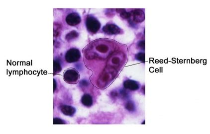 Hodgkin S Lymphoma Physiopedia