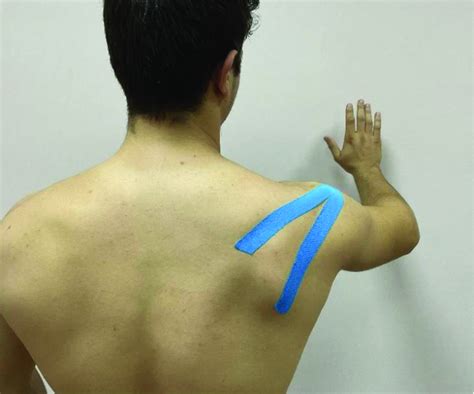 Clinical Taping Application Of Subscapular Muscle Download Scientific Diagram