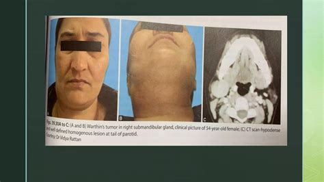 Salivary Glands Tumors Ppt