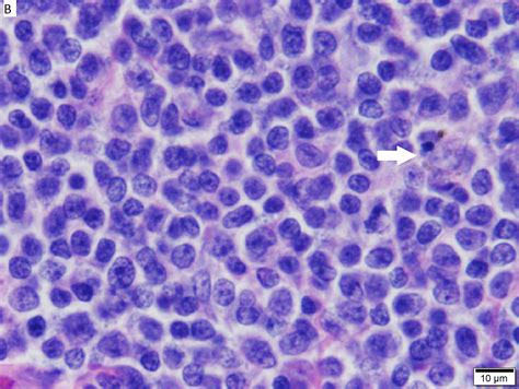 Non Chemotherapy Drugs For Mantle Cell Lymphoma Worthy Of Continued