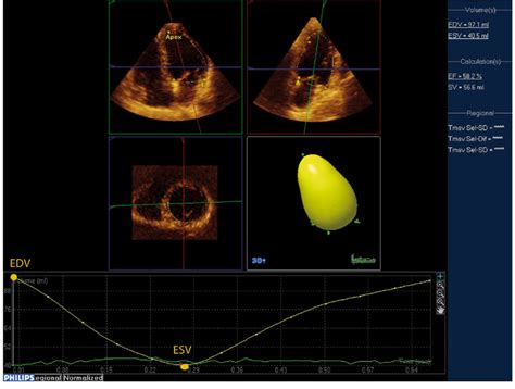 An Example Of Real Time 3 Dimensional Echocardiographic Quantification Download Scientific
