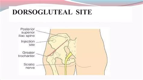 Intramuscular Injection Ppt