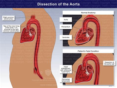 Dissection Of The Aorta Trial Exhibits Inc