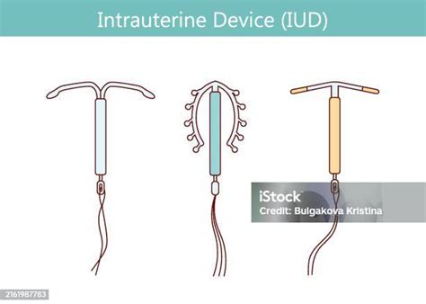 자궁 내 장치 또는 Iud 자궁 내 피임 장치 벡터 일러스트 레이 션 0명에 대한 스톡 벡터 아트 및 기타 이미지 0명