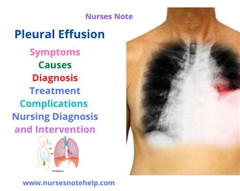 Pleural Effusion Symptoms Causes Diagnosis Treatment Complications