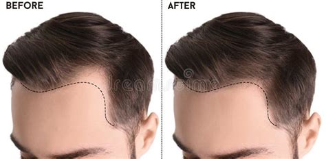 Hombre Joven Antes Y Despu S Del Tratamiento De La P Rdida De Pelo