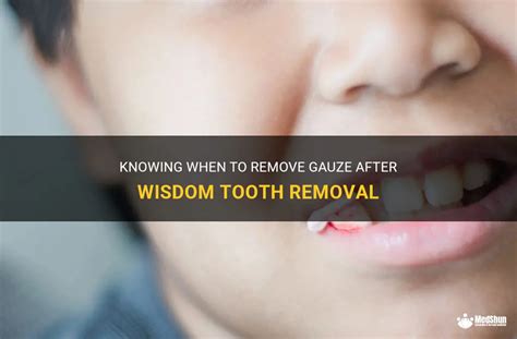 Knowing When To Remove Gauze After Wisdom Tooth Removal Medshun