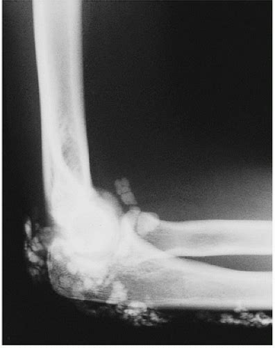 Skeletal And Extraskeletal Calcification And Ossification Syndromes