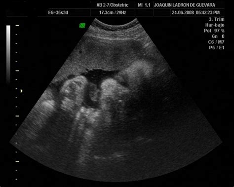 Ecografia 6 Meses De Embarazo Imagui