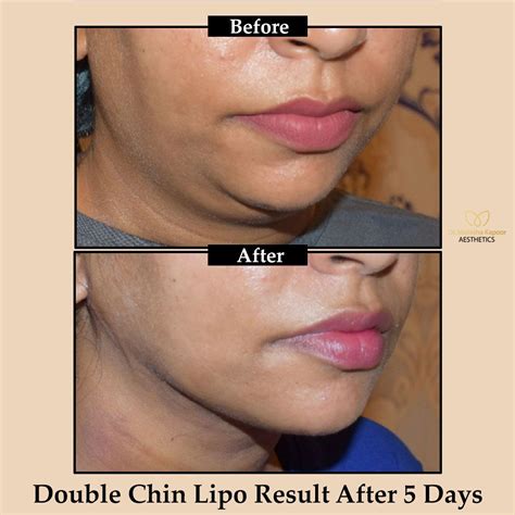 Double Chin Removal Artofit