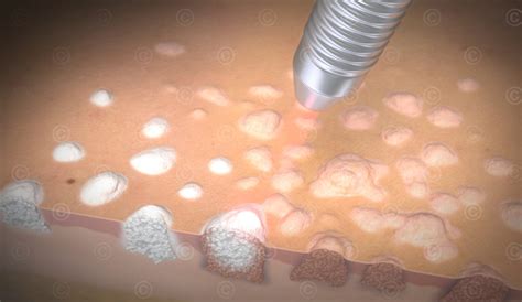 Illustration Behandlung Feigwarzen MedicalGraphics