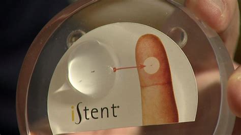 Istent Helps Relieve Eye Pressure For Glaucoma Patients Smallest