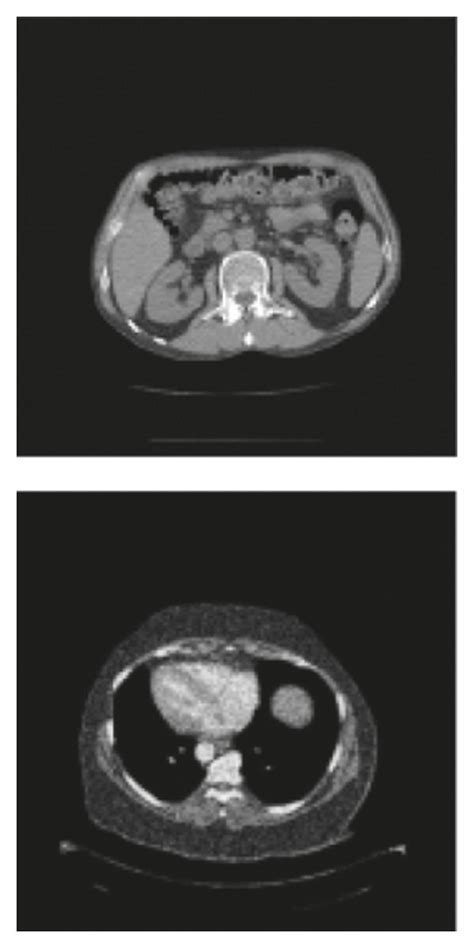 Denoising Results Comparison Images A Original Ct Image B