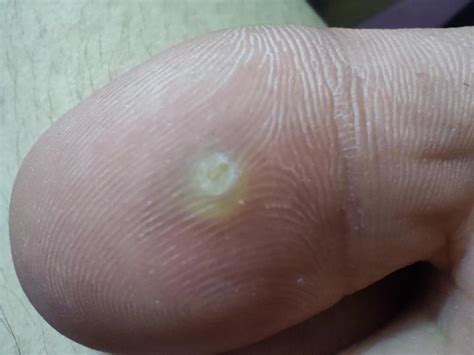 个人经历治愈鸡眼全过程（带全图） 知乎