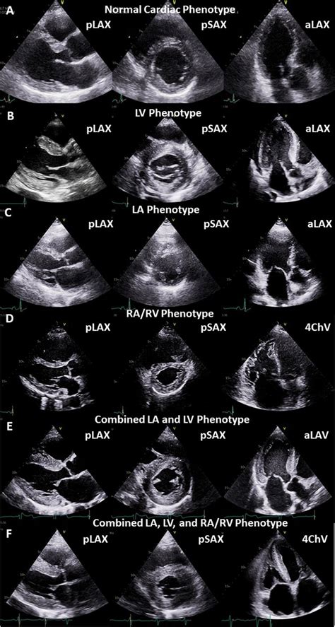 Illustration Of Cardiac Phenotypes In Patients With “hfpef” Symptoms By Download Scientific
