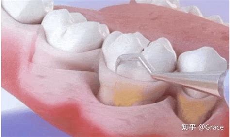 科普 牙周炎及治疗 知乎