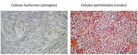 Gist Diagnostic Info Sarcomes