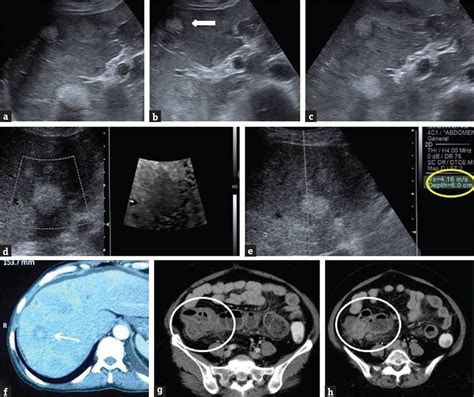 Role Of Acoustic Radiation Force Impulse Elastography In The