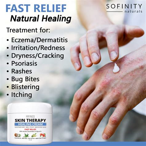 Eczema Rash Treatment Cream At Charlie Oshanassy Blog
