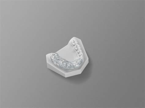 Surgical Guide Tooth Supported Implant