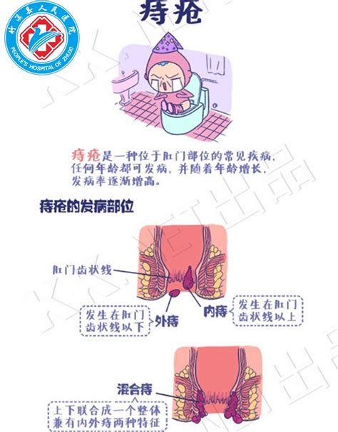 有“籽”难言：痔疮发作怎么办？ 竹溪县人民医院官网