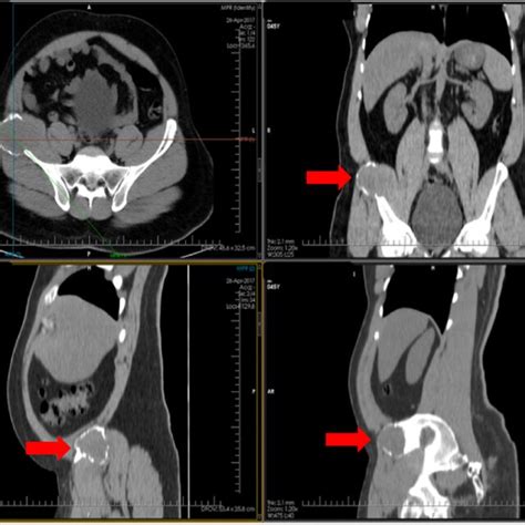 Ct Scan Of Neck Axial Coronal And Saggital View Reformatted Images