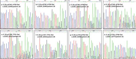 Sequencing Peak Maps Of Egfr Mutations In Exons 18 19 20 And 21