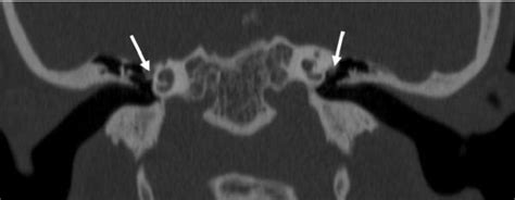 Coronal High Resolution CT Temporal Bone Image Showing Bilateral Download Scientific Diagram