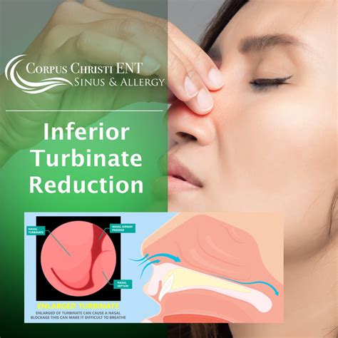 Inferior Turbinate Reduction Corpus Christi Ent Sinus And Allergy