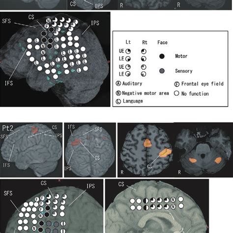 Bold Signal Activation Of Functional Mri Fmri During A Motor Task And