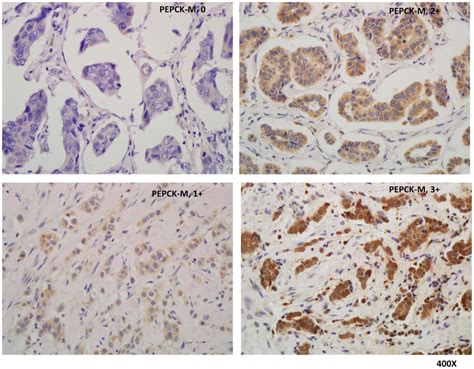 The Representative Immunohistochemical Stainings 0 1 2 And 3 Of