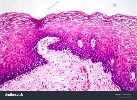 Squamous Cell Hyperplasia Over 6 Royalty Free Licensable Stock Illustrations And Drawings