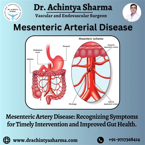 Needs To Understand About Mesenteric Artery Disease Symptoms