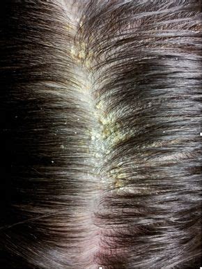 Scalp Buildup Causes Treatment And Prevention Artofit