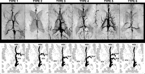 Variability Of Cerebral Deep Venous System In Preterm And Term Neonates