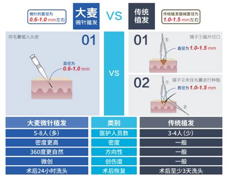 这几个治疗脱发的方法，大麦微针植发帮你整理好了！ 知乎
