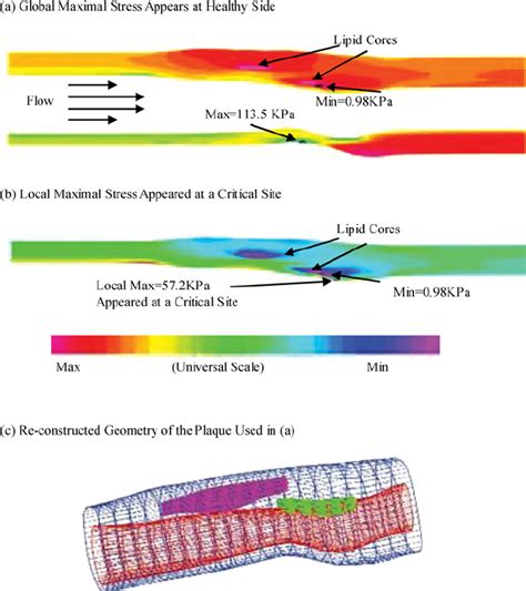Global Maximal Stress Often Appears At Healthy Parts Of The Vessel Download Scientific Diagram