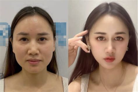 轮廓固定手术是什么？效果怎么样？有真实案例分享一下吗？ 知乎