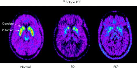 Positron Emission Tomography Brain