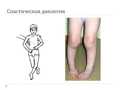 Детский церебральный паралич ДЦП презентация онлайн