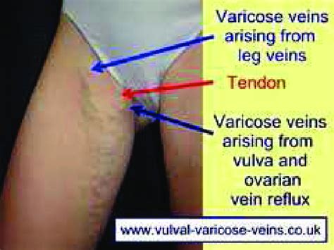 Vulval Varicose Veins Quoted From Google Com Download Scientific Diagram