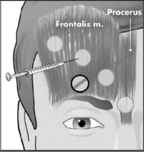 Frontalis Muscle Botox